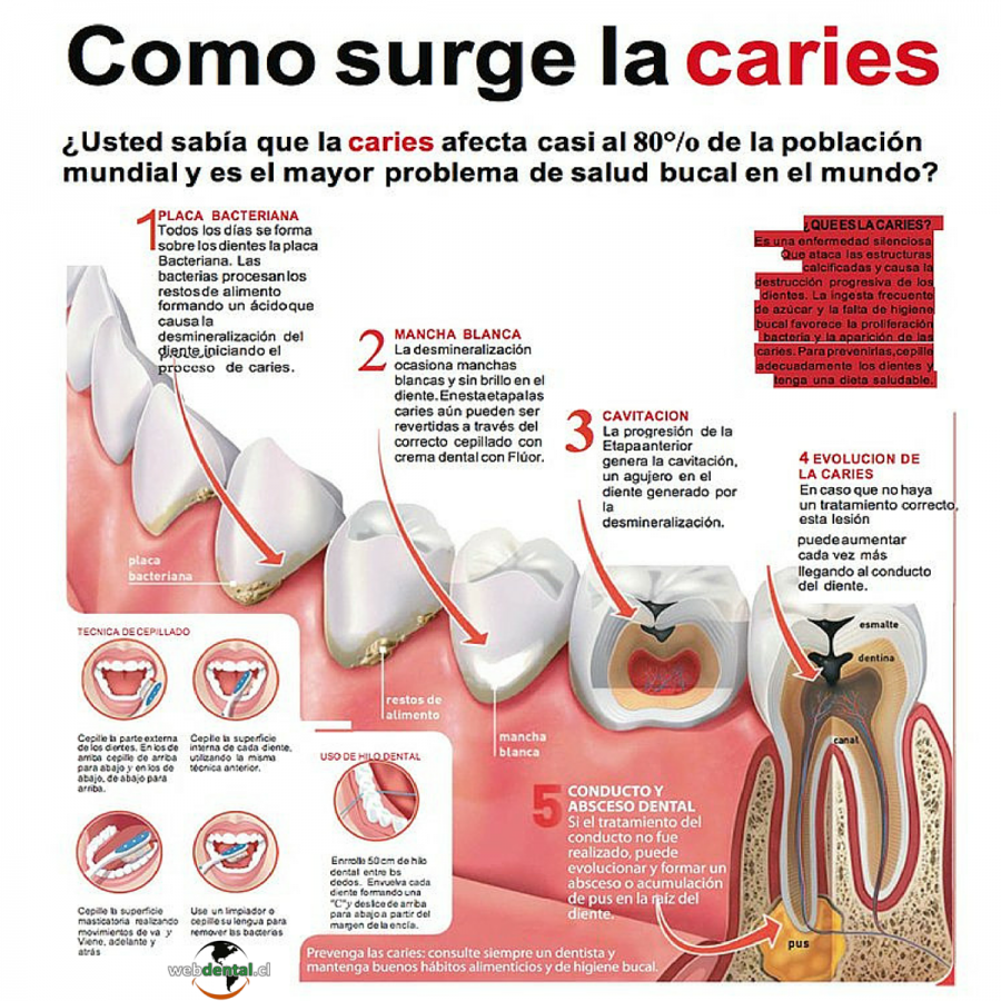 Origen de las caries | webdental.cl | Noticias de Odontologia