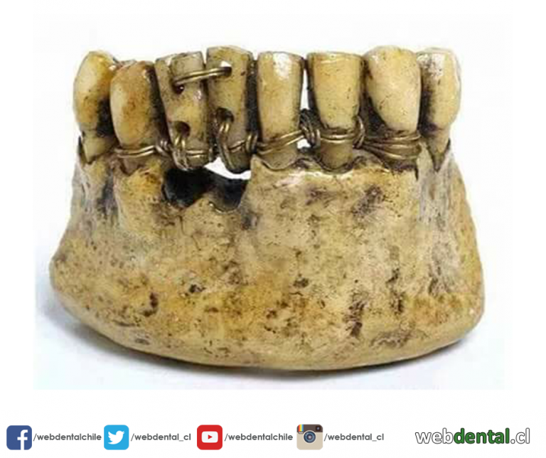 Prótesis dental en la antigua Roma | webdental.cl | Noticias de Odontologia