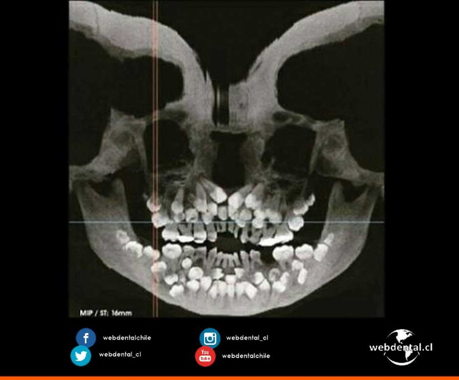 Dientes Supernumerarios | webdental.cl | Noticias de Odontologia