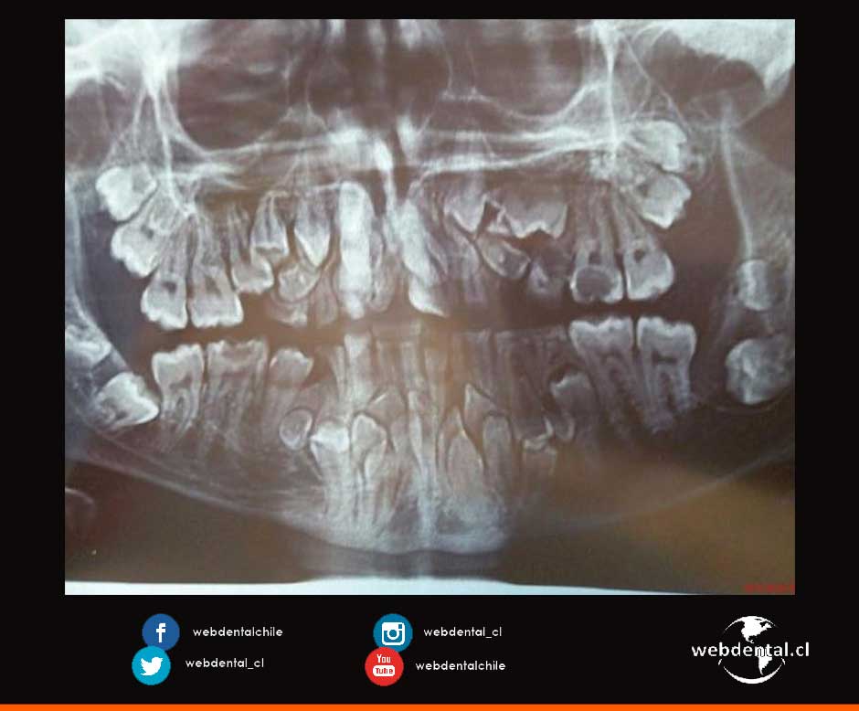 Una caso de dientes supernumerarios | webdental.cl | Noticias de ...